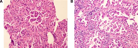 Pathological Images Show The Morphology Of A Micropapillary Pattern Download Scientific