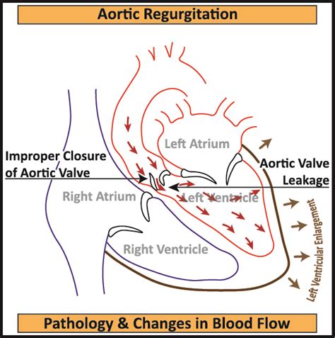 Minimally Invasive Aortic Valve Replacement