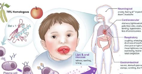 구강 알레르기 증후군 꽃가루 음식 알러지 관련있는 면역반응기전