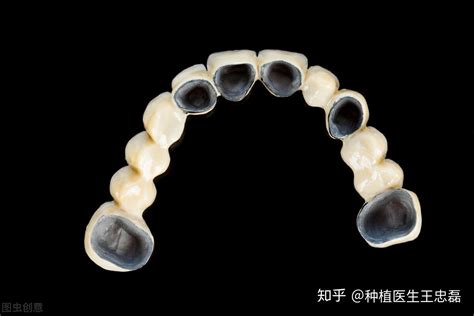 烤瓷牙多久要换烤瓷牙出现崩瓷发黑就该注意了 知乎
