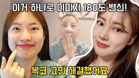 코성형 And 안면윤곽 사각턱 And 쌍수 코라인 하나로 이미지가 이렇게나 바뀐다고 복코 수술로 연예인 코 부럽지 않다 성형 전후 과정 회복 과정까지 낱낱이 공개 [쀼