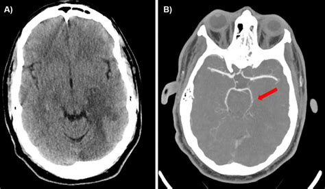 Ct Head Demonstrating Left Parieto Occipital Hypodensity With Localized Download Scientific