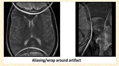 Mri Artifacts Pptx Medical Tests Medical Health