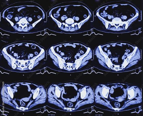 Ct Computed Tomography Scan Of Whole Abdomen Soft Tissue Mass In
