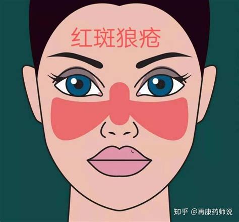 红斑狼疮是什么病？会传染吗？ 知乎