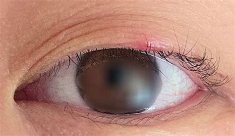 눈꺼풀에 다래끼가 생긴걸까요 지식in
