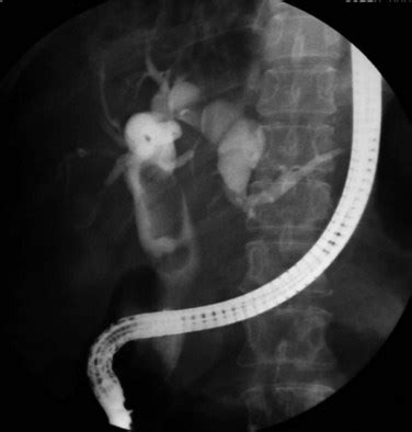 Recurrent Pyogenic Cholangitis Abdominal Key
