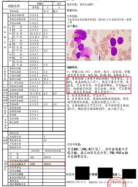 治療相關免疫分型不典型急性早幼粒細胞白血病1例 每日頭條