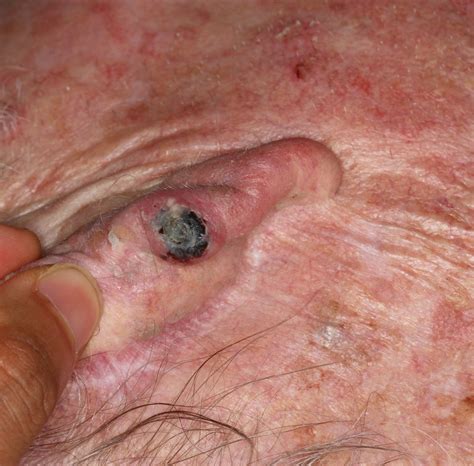 Understanding Squamous Cell Carcinoma