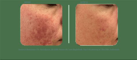 Treatment Rosacea Formatk