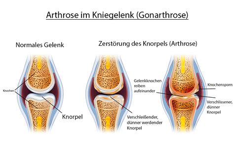 Hyaluronsäure Helfen Knie Spritzen gegen Schmerzen