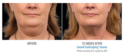 Coolsculpting Chin Before And After Double Chin Fat Freezing Near Me Uk