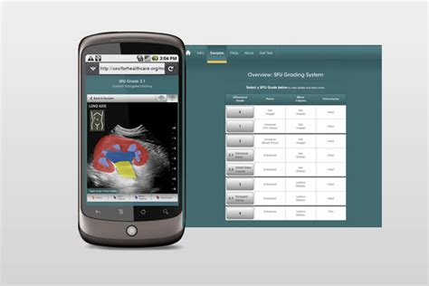 Sfu Grading Hydronephrosis Grading System And Mobile Web App Society For Fetal Urology