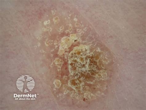 Seborrhoeic Keratoses Dermoscopy Images