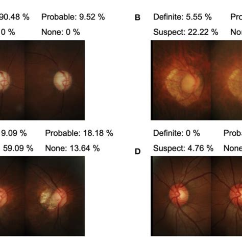 Figure E Examples Of Representative Optic Disc Photographs Of Various Download Scientific