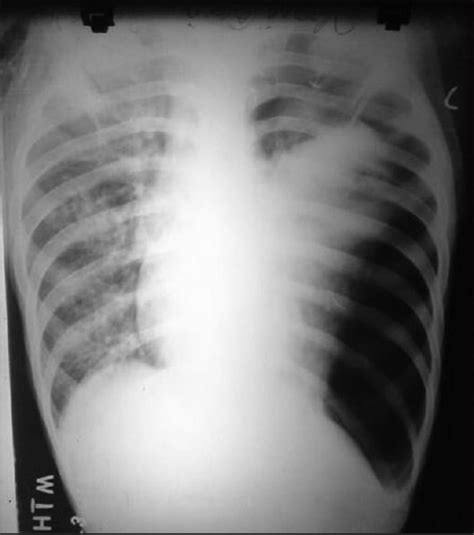 Unusual Presentation Of Pulmonary Nocardiosis As Pyopneumothorax In Hiv