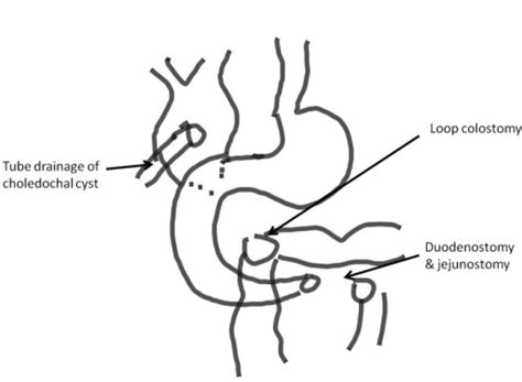 Figure 3 Surgical Procedure External Drainage Of Chol Open I
