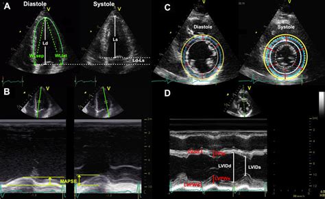 Relations Of The Strains To The Systolic Deformation Of The Left Download Scientific Diagram