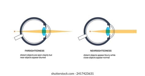 Myopia Hyperopia Eye Disease Anatomical Poster Stock Vector Royalty Free 2417423631 Shutterstock