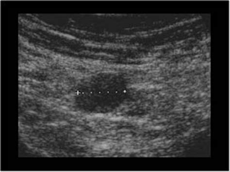 Abdomen And Retroperitoneum 1 5 Appendix Case 1 5 5 Mucocele Or