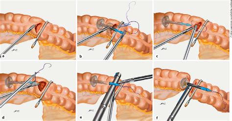 Figure 2 From Totally Laparoscopic Low Anterior Resection For Lower Rectal Cancer Combination