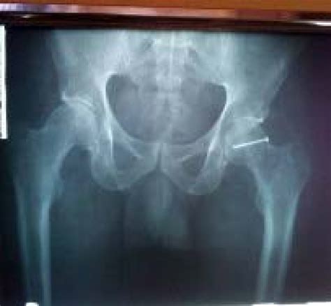 A 2 Years Anteroposterior X Ray After ORIF Download Scientific Diagram
