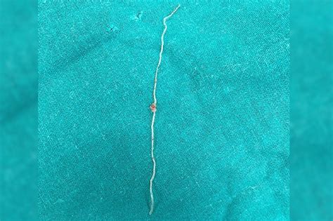 Mengerikan Parasit Tumbuh Di Pipi Wanita Ini Setelah Digigit Nyamuk