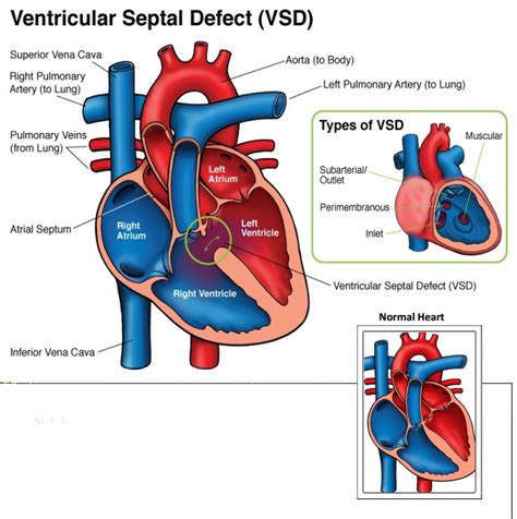 Post Delivery Graphic Anatomy Vsd Ob Images