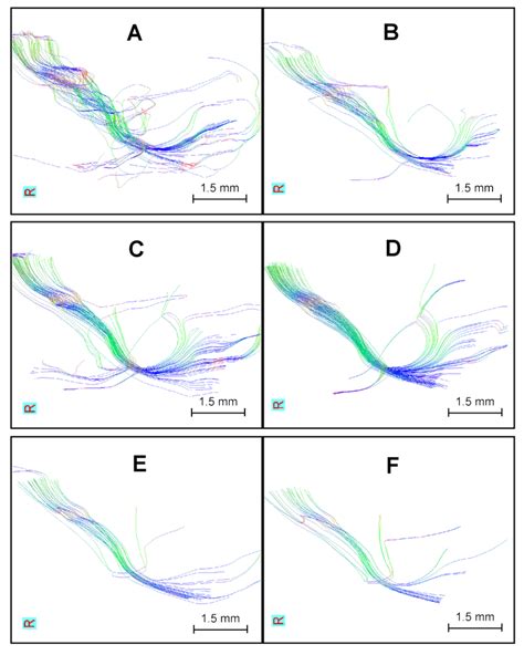Sagittal Views Of The Corticospinal Tract Cst In Different Spatial