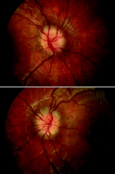 Distinguishing Optic Disc Drusen From Papilloedema The Bmj