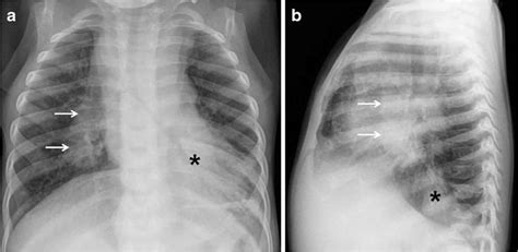Ghon Complex Ghon Focus Definition Chest X Ray And Causes