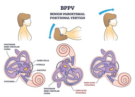 Benign Paroxysmal Positional Vertigo Bppv And Best Treatment