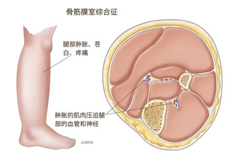 骨筋膜室综合征 医学插画