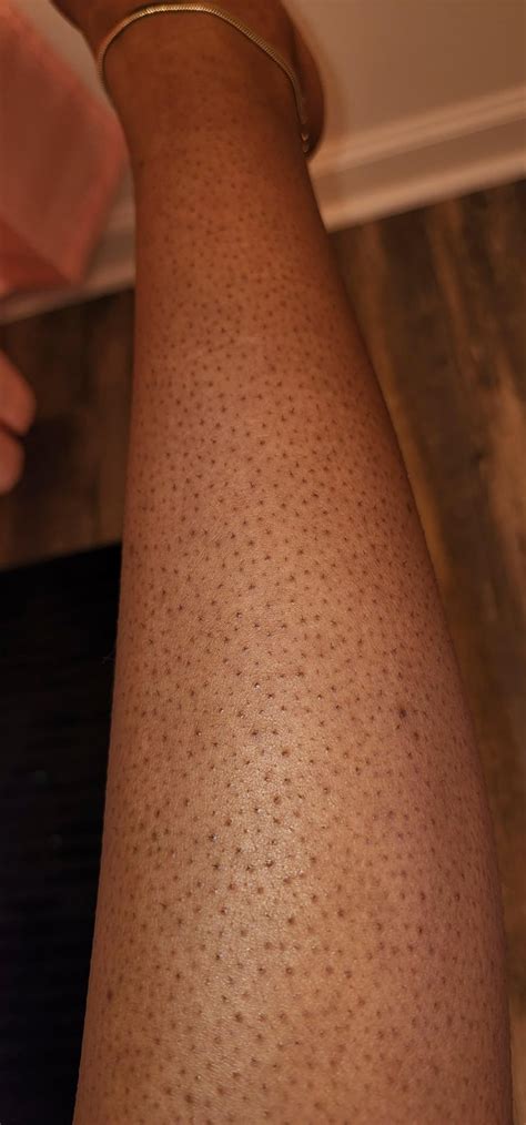 14 Month Old Has Kp R Keratosis