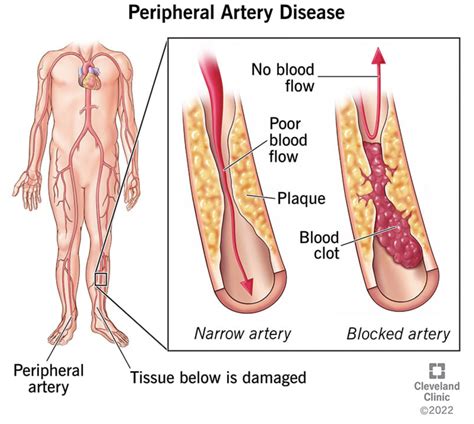 Migraine Peripheral Vascular Disease Angina All Linked To Ntg
