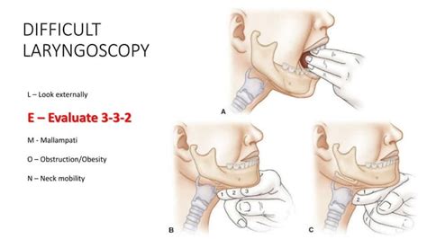 Airway Algorithm Pptx