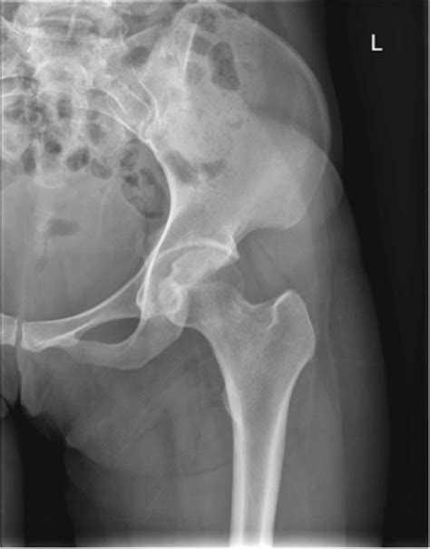 Hip X Ray Anatomy