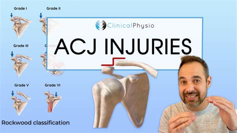 Acromioclavicular Joint Injuries Expert Physio Review Youtube