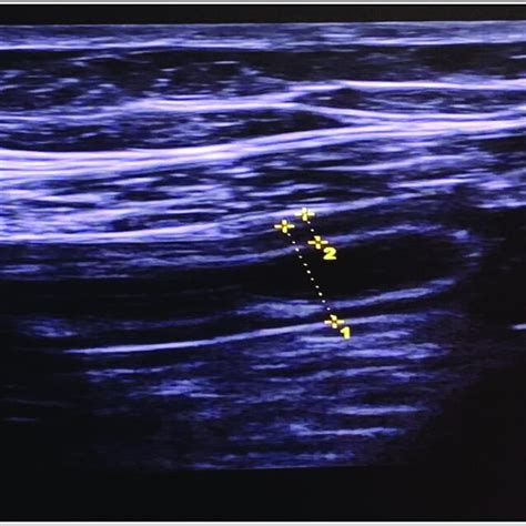 Ultrasound Of Appendix With Thick Wall More Than 6 Mm Download