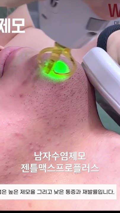 면도 이제 그만 수원수염제모로 깔끔한 남자 완성💈 젠틀맥스프로플러스 원스의원” 수원수염제모 남자제모 젠틀맥스프로