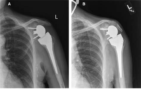 Uw Shoulder And Elbow Academy Acromial Base Fractures After Reverse Total Shoulder Arthroplasty