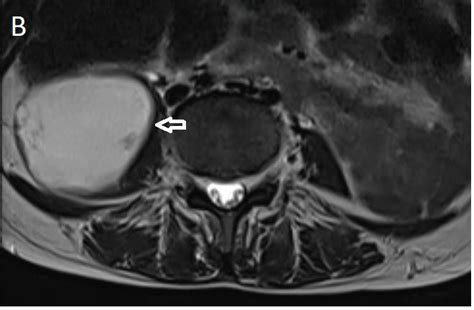 B Axial T2 Weighted Image Showing Right Sided Psoas Abscess Download