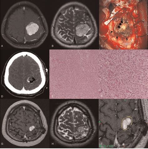 Contrast Enhanced Brain Mri Showed A 47 Cm Sized Heterogeneously Download Scientific Diagram