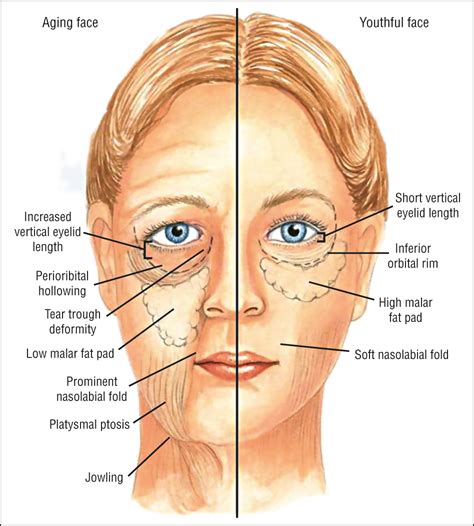 Melolabial Fold Vs Nasolabial Related Keywords And Suggestions Melolabial Fold Vs Nasolabial