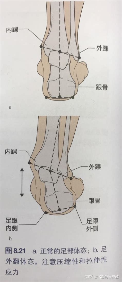 小腿肌肉三巨头系列解决膝关节疼痛小腿外翻胫骨外旋和功能扁平足的关键点之胫骨后肌 知乎