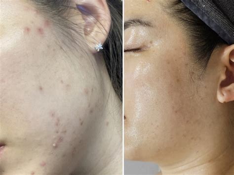 성인여드름 화농성 피부뒤집어짐 겪고나서 내가 절대로 하지 않는 것 피부관리 홈케어 꿀팁 네이버 블로그