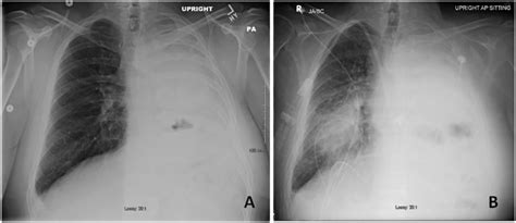 A Fatal Case Of Penile Calciphylaxis Pmc