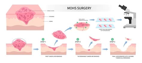 Mohs Surgery And Facial Skin Cancer Sydney — Hunters Hill Dermatology Sydney Dermatologists