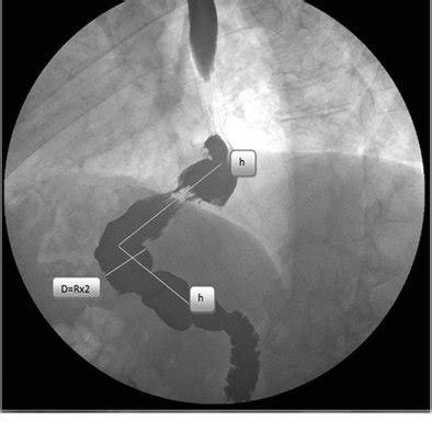Volume Measurements In An EGD Transit H Height D Diameter R Radius Download