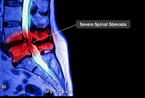 Spinal Stenosis Mri